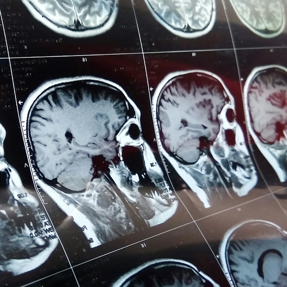 Leading Concussion Care Plan by NPG Brain